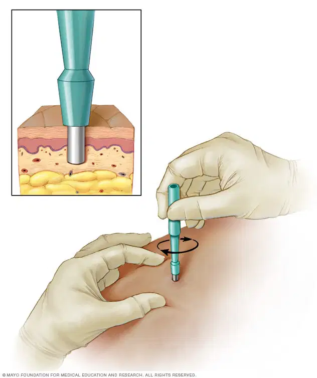 Prueba sobre Biopsia y Cáncer Quiz