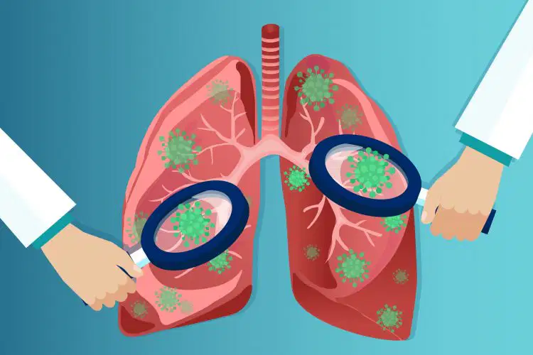 Pneumonia Concepts 11th Grade Quiz | Wayground