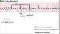 EKG Patterns Atrial Flutter & Atrial Fibrillation Interactive Video